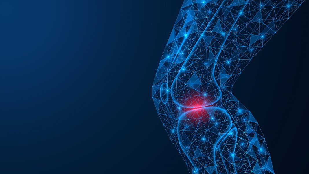AI can now be used to detect early knee osteoarthritis
